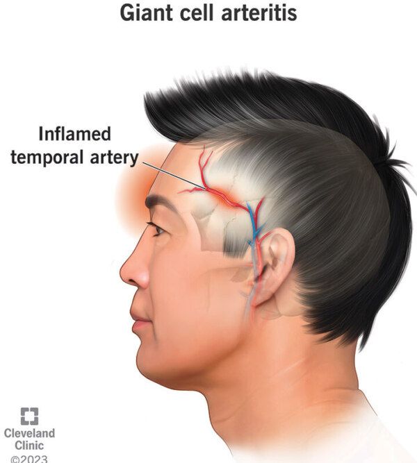 TRATAMIENTO y PREVENCIÓN de la ARTERITIS TEMPORAL